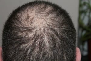 Diffuser Haarausfall beim Mann: Ursachen, Verlauf und Möglichkeiten ...